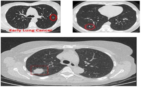 An Effective Method For Lung Cancer Diagnosis From Ct Scan Using Deep Learning Based Support