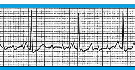 Ecg Interpretation Ecg Blog 139 Atrial Flutter Av Block Artifact Sinus Rhythm