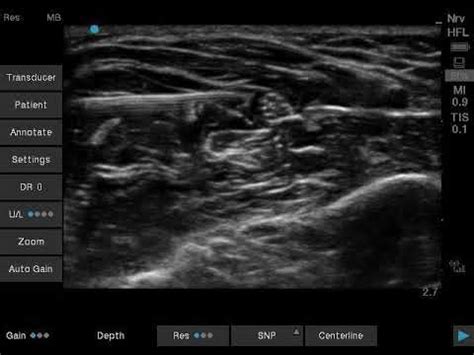 Median Nerve Block Searcy EM