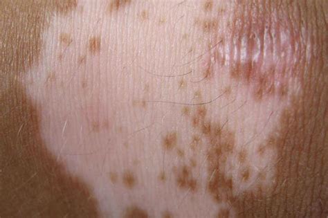 白斑种类 白斑种类图片 第3页 大山谷图库