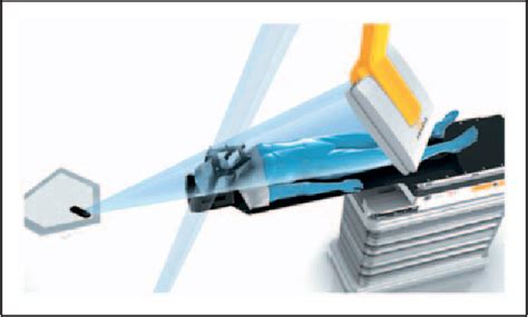 Figure 2 From Frameless Linac Based Stereotactic Radiosurgery Treatment For Sunct Syndrome