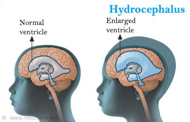 Hydrocephalus What Causes Too Much Fluid On The Brain Challenging Skills