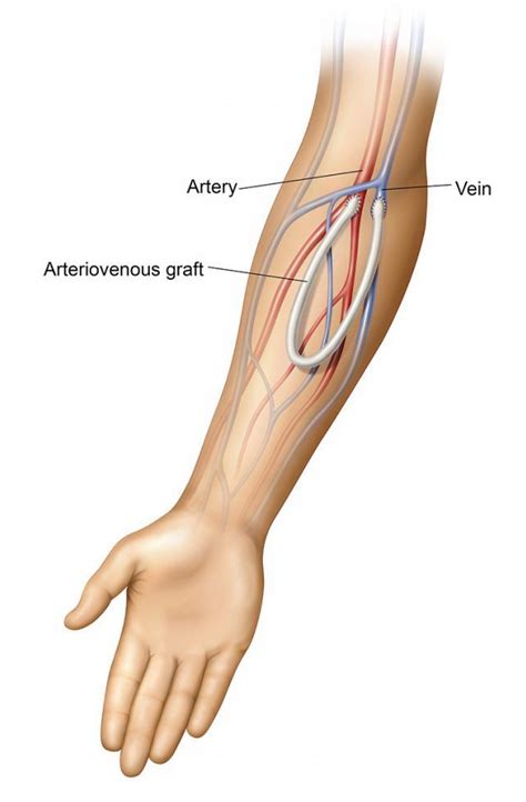 Understanding Arterial Venous Grafts In Hemodialysis A Lifeline For