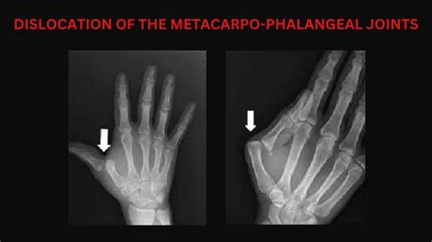 Dislocation Of The Metacarpo Phalangeal Joints Mcp Joint Dislocation Hyperextension Injuries