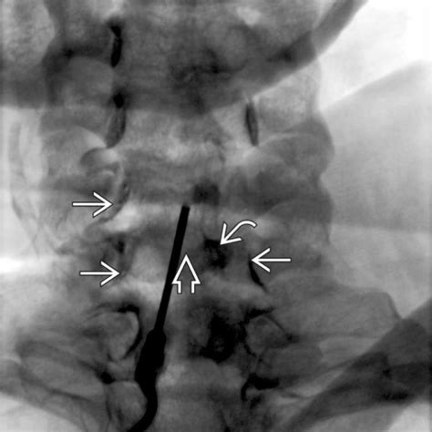 Epidural Steroid Injection Cervical Spine Clinical Tree