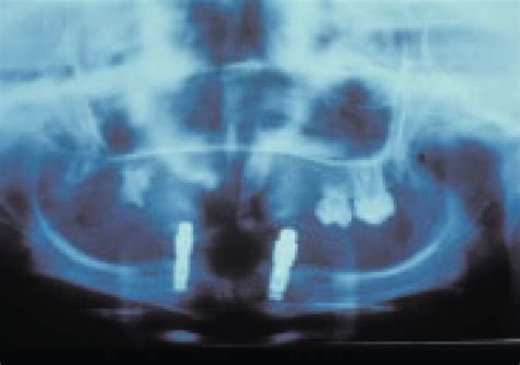 Mandibular Implants In A Young Man With An Ectodermal Dysplasia Download Scientific Diagram