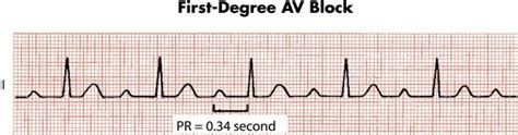 First Degree Av Block