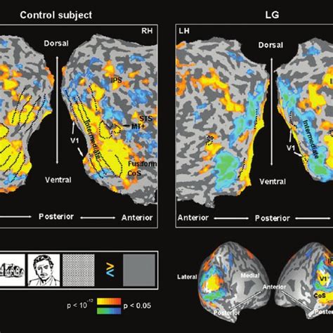 Visual Activation Lg Versus Control Left Typical Control Subject