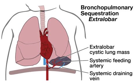 Pulmonary Sequestration