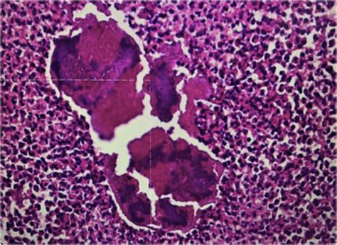 Exophytic Botryomycosis An Unusual Clinical Presentation Anais