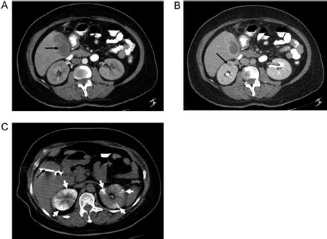 Radiocontrast Enhanced Abdominal Ct A Arterial Phase Disclosing