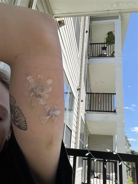 This Is My Third Time Getting Nexplanon R Nexplanon