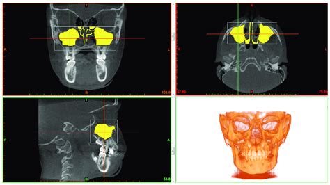 Sagittal Coronal And Axial View Of The Maxillary Sinus The Isolated