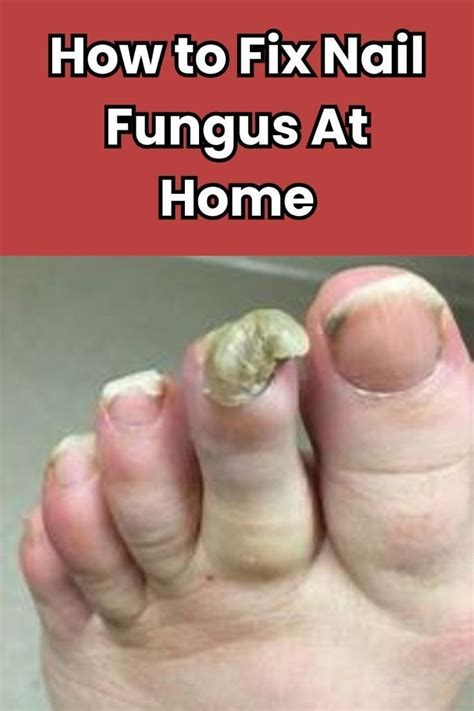 Pin On Fungal Nail Infections