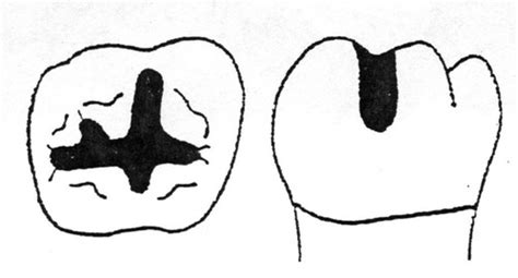 Blacks Classification Of Cavities Flashcards Quizlet