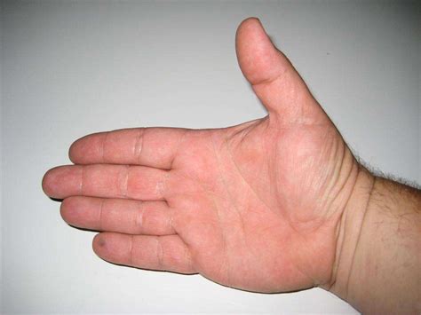 Scleroderma 10 Scleroderma Symptoms