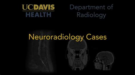 Hypoplastic A1 Segment Of The Anterior Cerebral Artery Youtube