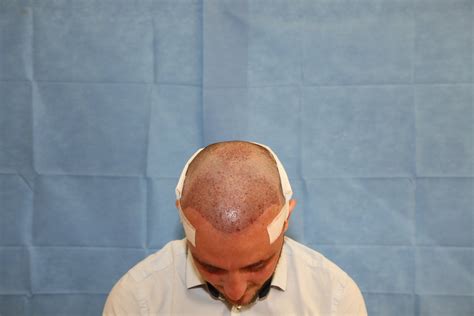 Dr Raghu Reddy 3107 Grafts Results Posted By Leading Hair