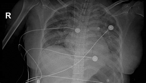 Bedside Cxr After 2 Days Of Admission Cxr Chest X Ray Download Scientific Diagram