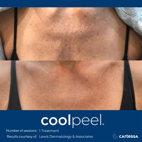 Cool Peel Co2 Laser Resurfacing — The Skin Spot Laser Club Cape Coral