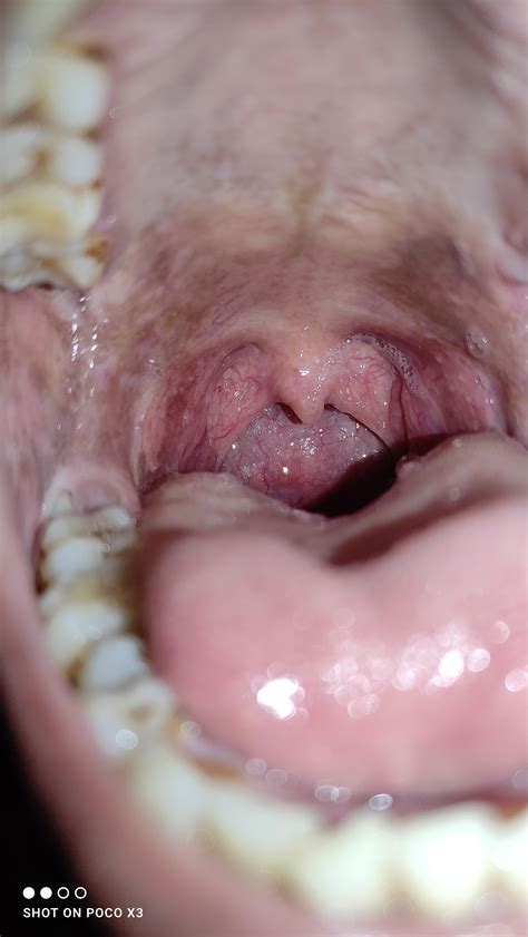 Mouth Decease Raskdoctorsmeeee