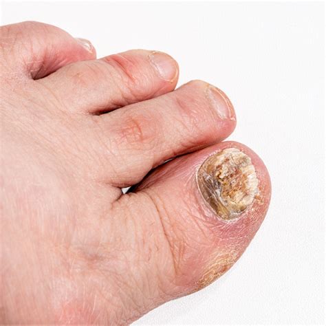 Addressing Nail Fungus A Crucial Step Towards Healthier Feet