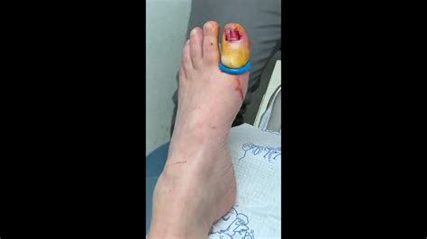 Total Matrixectomy Youtube