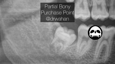 Partial Bony Impaction Extraction Using Purchase Point With Cogswell B Elevator Youtube