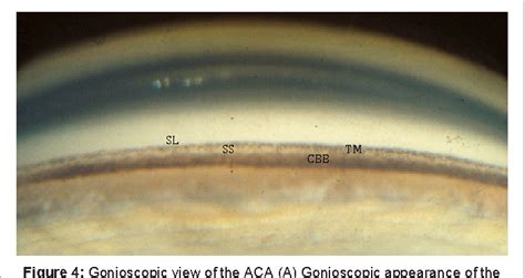Figure 9 From Angle Closure Glaucoma Pathogenesis And Evaluation A Review Semantic Scholar