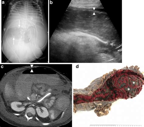 Toxic Megacolon A Abdominal Radiograph In A 6 Year Old Girl With C Download Scientific