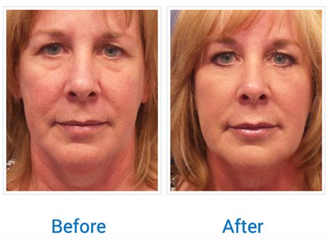 Botox® And Fillers Patient Oc Dermatology