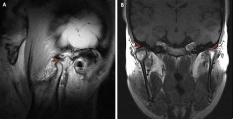 Imaging Of The Tmj Region And Mandibular Condyle In Sagittal A And