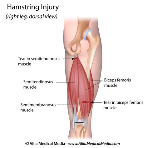 Proximal Hamstring Repair Dr Lucas MD