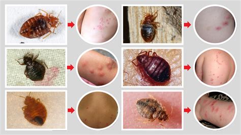 What Do Bed Bug Bites Look Like On Humans Images