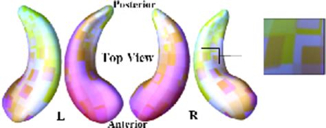 Applying Sparse Coding To Surface Multivariate Tensor Based Morphometry To Predict Future