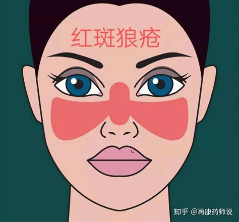 红斑狼疮是什么病？会传染吗？ 知乎