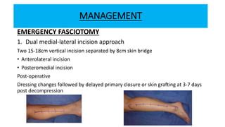 Compartment Syndromepptx