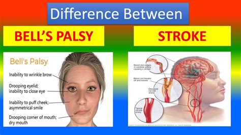 Difference Between Cva And Stroke