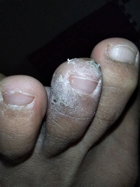 Masalah Pada Jari Kaki Hellosehat