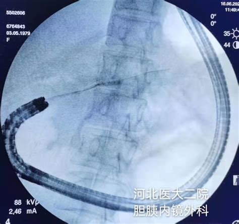 分享一例常规的胃肠改道术后ercp胆胰内镜网