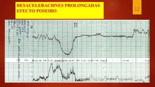 6desaceleraciones Prolongadaspptx