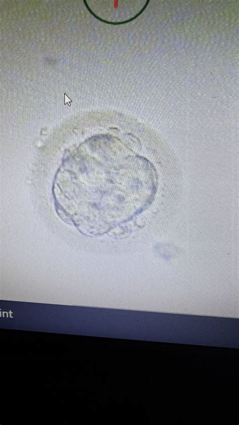 Embryo Thawing Two Morula Day 5 After Thawing Two Blastocyst ♥️♥️