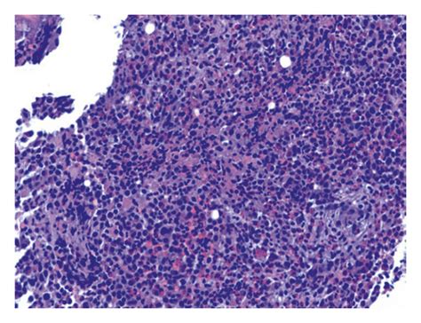 Area Of Hypercellular Bone Marrow With Red Cell Aplasia Download