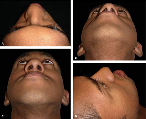 The Malar Region Plastic Surgery Keyplastic Surgery Key