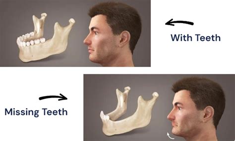 Aligners Toothly Dental