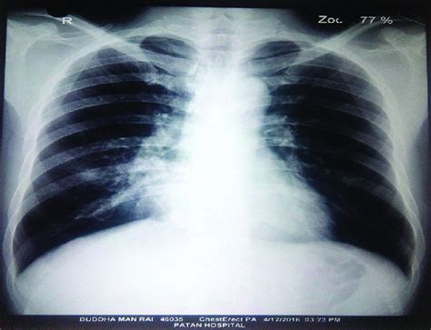 Chest Xray Showing Increased Bronchovascular Markings In Right Download Scientific Diagram