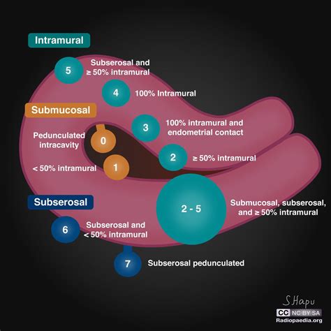Uterine Leiomyoma Fibroid Classification System Illustration