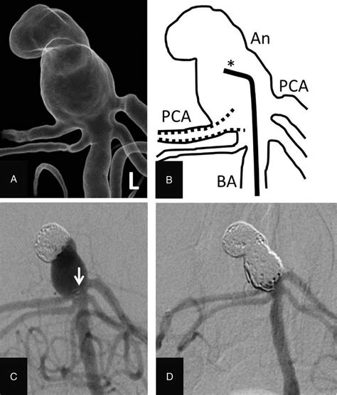 DSA During Operation And Schematic Drawing Of Preoperative Planning For Download Scientific