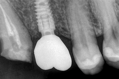 Synthetic Approach For Socket Preservation Dr E Mota Indication Matrix