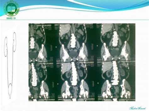 Lap Nephrectomy Case Ppt Ppt